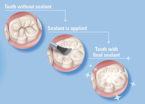 How Do Sealants Work? (Why they are worth the investment for your kids)
